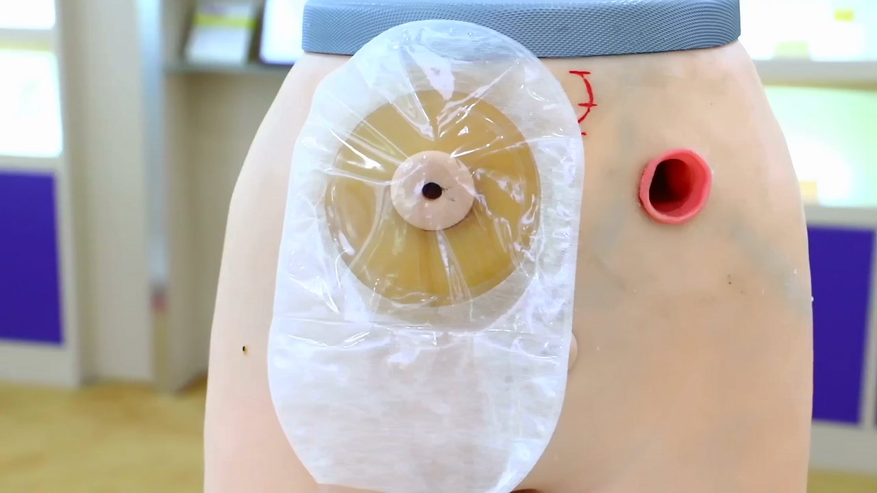 What is an ostomy bag?