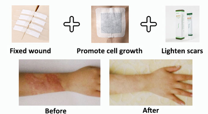 Surgical wound closure for Cesarean section
